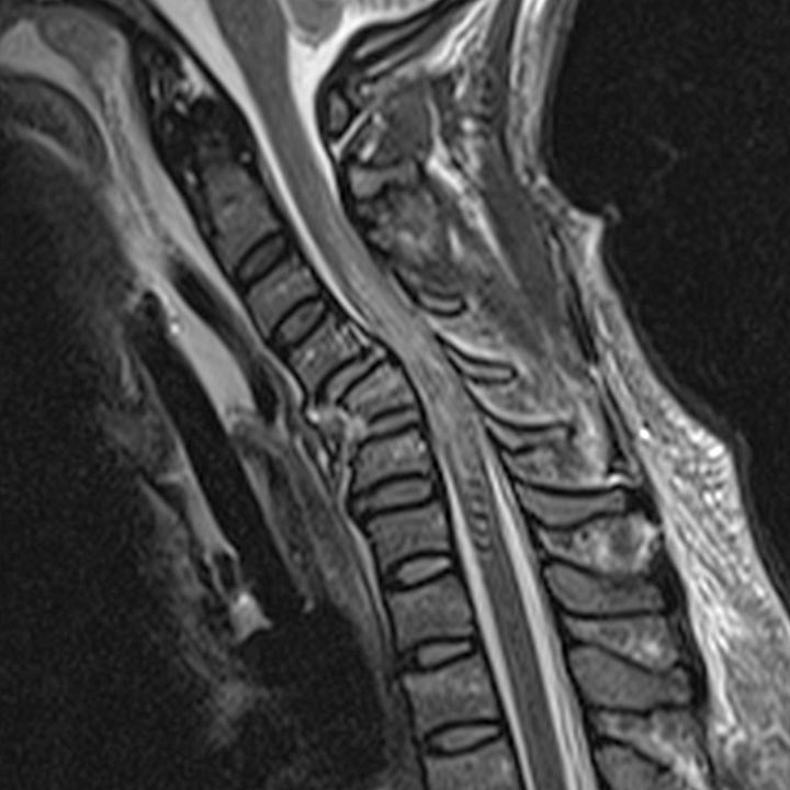 Cervical Spine Hyperflexion Injuries - by Alexander Baxter