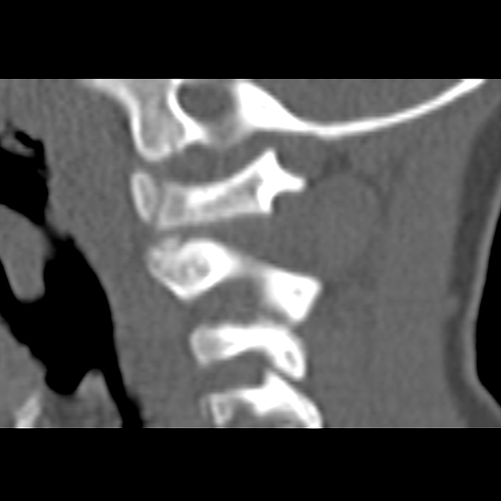 Atlantoaxial rotatory subluxation - by Alexander Baxter