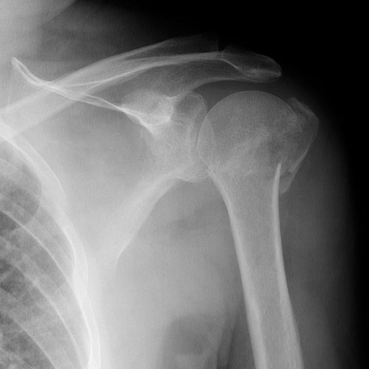 Humeral head and neck fractures - by Alexander Baxter