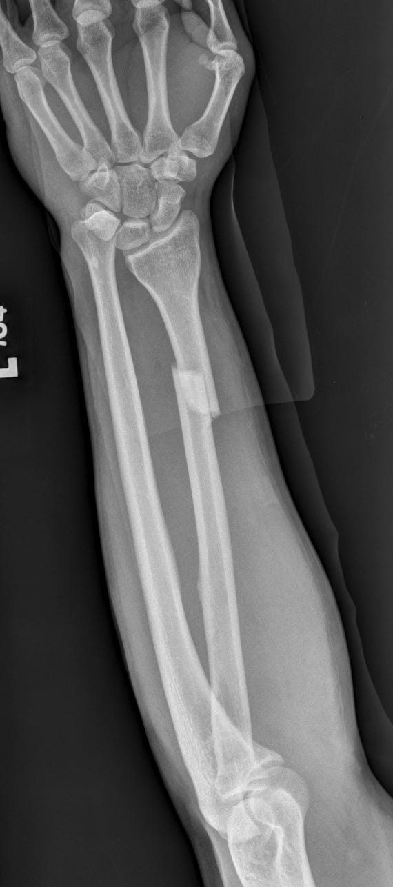 Forearm fractures - by Alexander Baxter - RadNotes