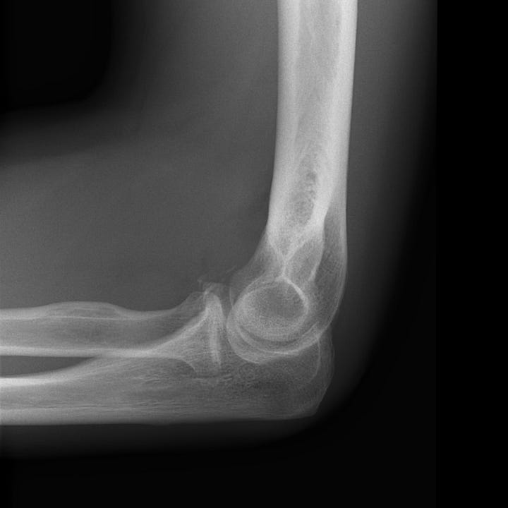 Radial Head Fracture And Essex Lopresti Fracture Dislocation