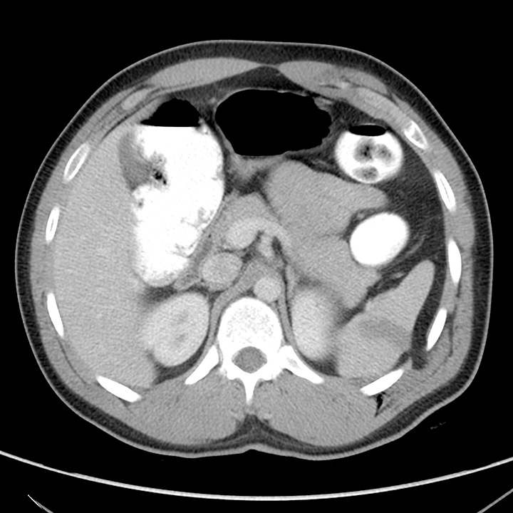 Splenic injury - by Alexander Baxter - RadNotes