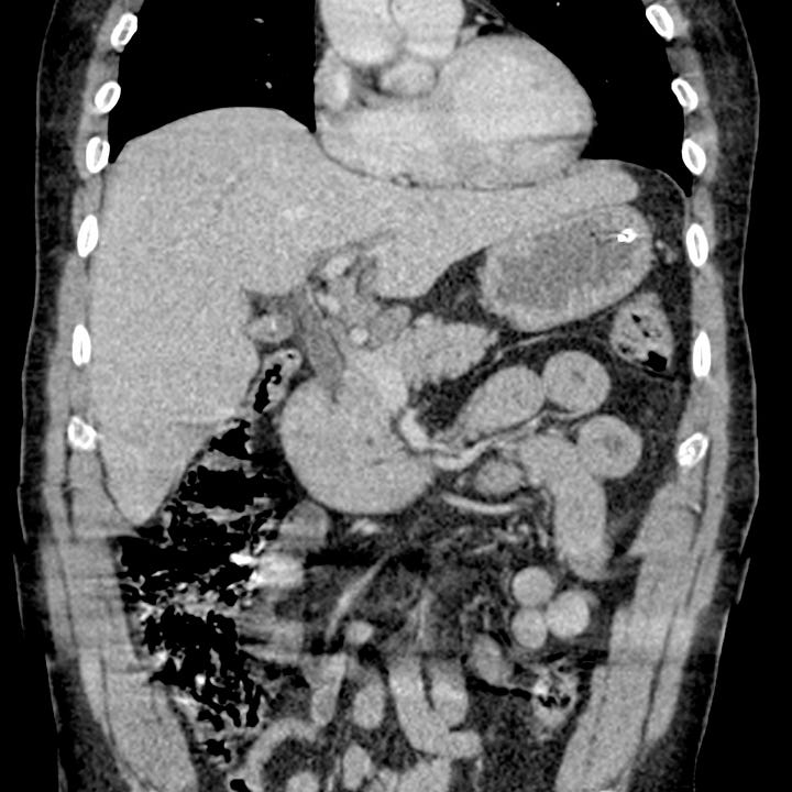 Small bowel injury - by Alexander Baxter - RadNotes