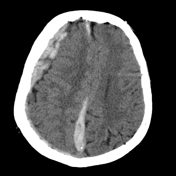 Acute Subdural Hematoma - by Alexander Baxter - RadNotes