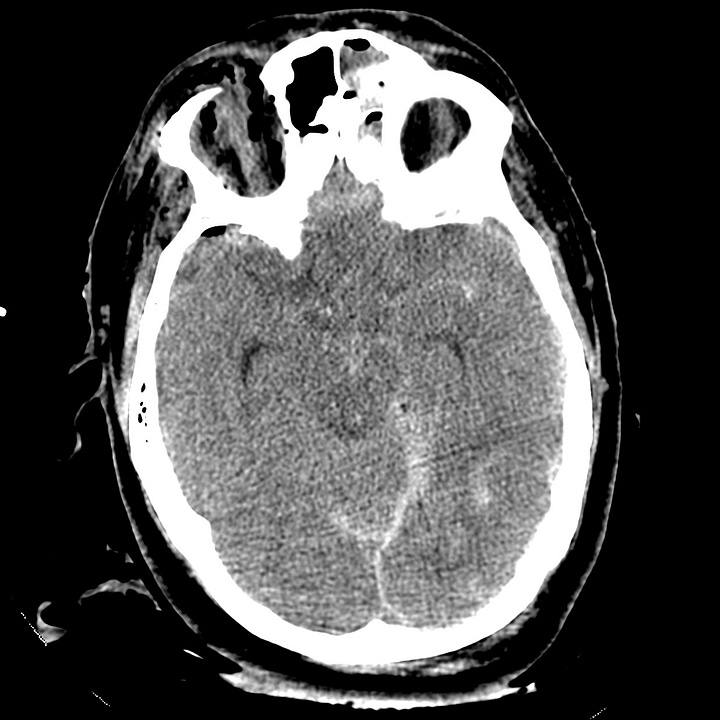 Traumatic subarachnoid hemorrhage - by Alexander Baxter