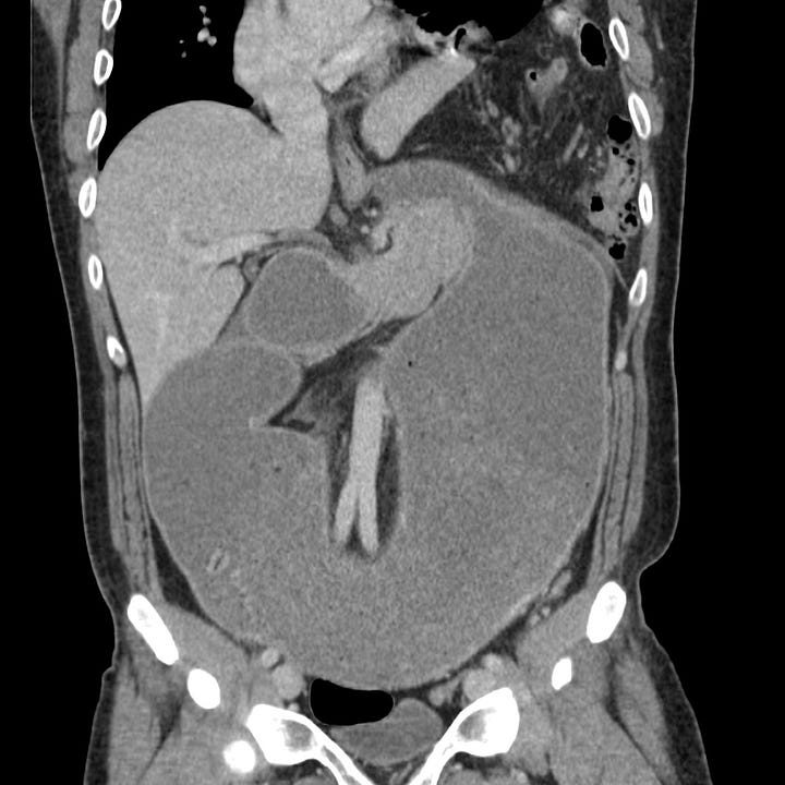 Gastric outlet obstruction - by Alexander Baxter - RadNotes
