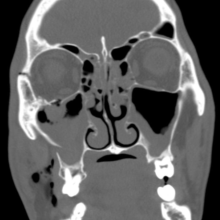 Zygomaticomaxillary Complex Fracture - by Alexander Baxter