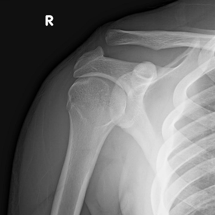 Acromioclavicular separation - by Alexander Baxter