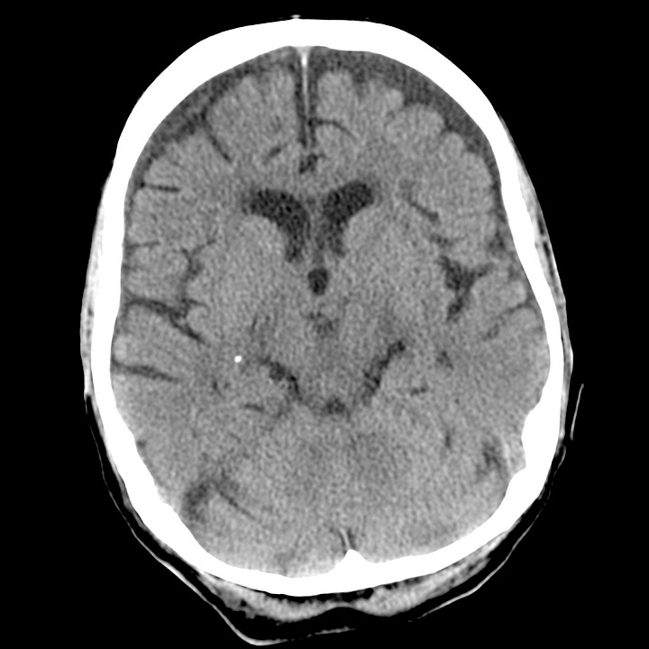 Subdural hygroma - by Alexander Baxter - RadNotes