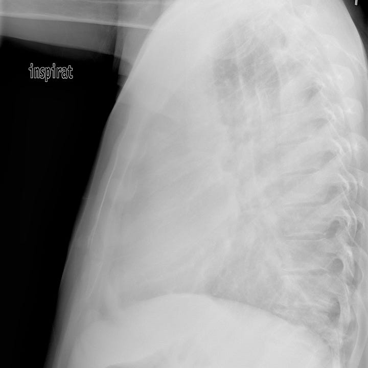 Traumatic hemothorax - RadNotes
