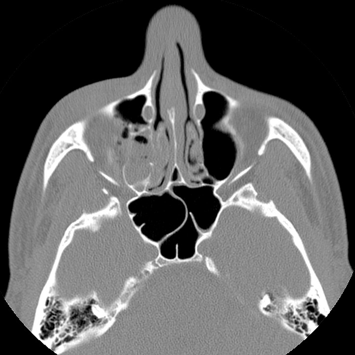 Orbital wall fractures - by Alexander Baxter - RadNotes