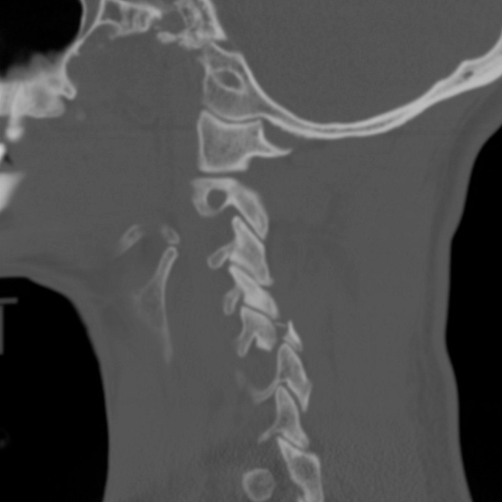 Cervical Spine Hyperflexion Injuries - by Alexander Baxter