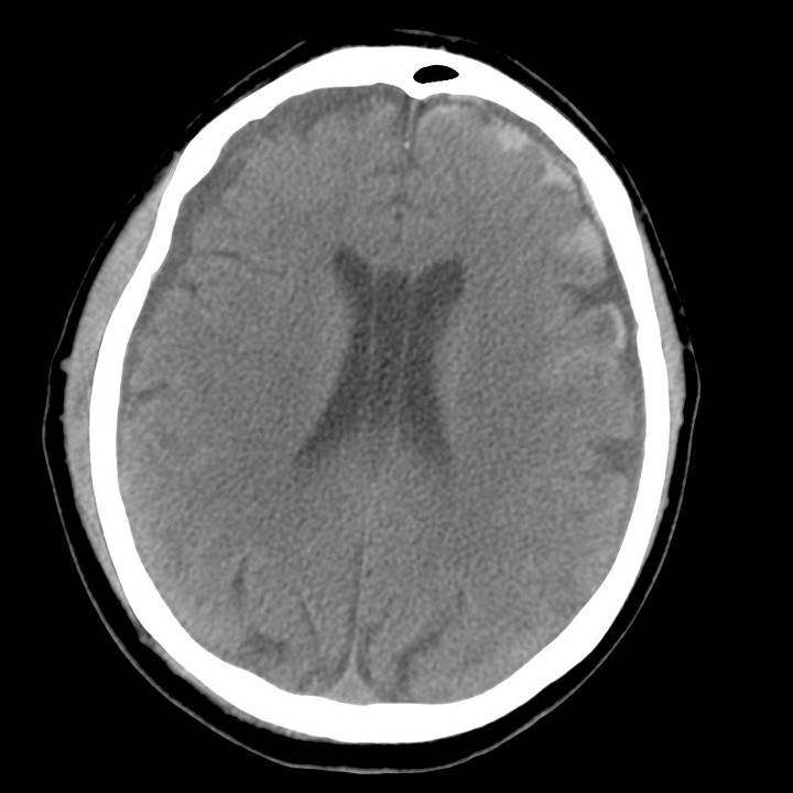 Subdural hygroma - by Alexander Baxter - RadNotes