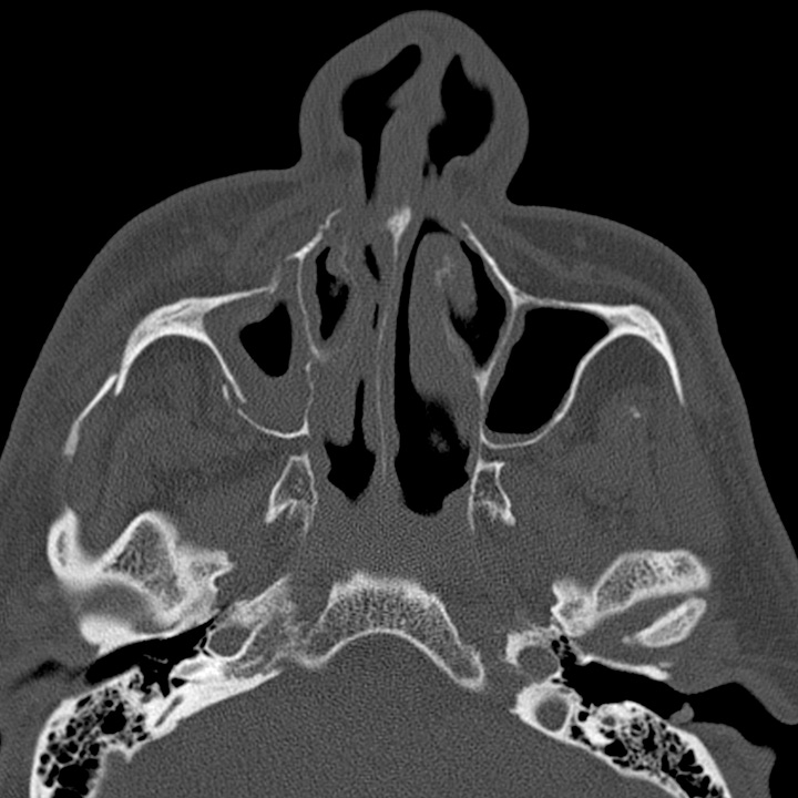 Zygomaticomaxillary Complex Fracture - by Alexander Baxter