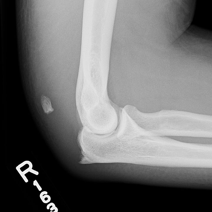 Olecranon fracture and triceps avulsion