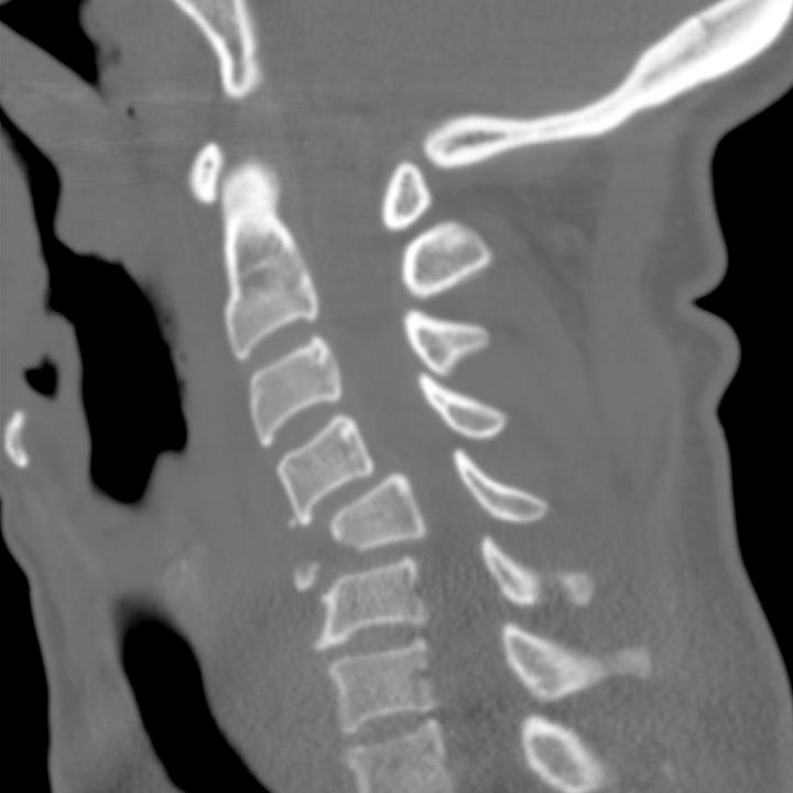 Cervical Spine Hyperflexion Injuries - by Alexander Baxter