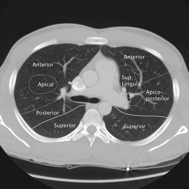 Chest anatomy - radiographs and CT - by Alexander Baxter
