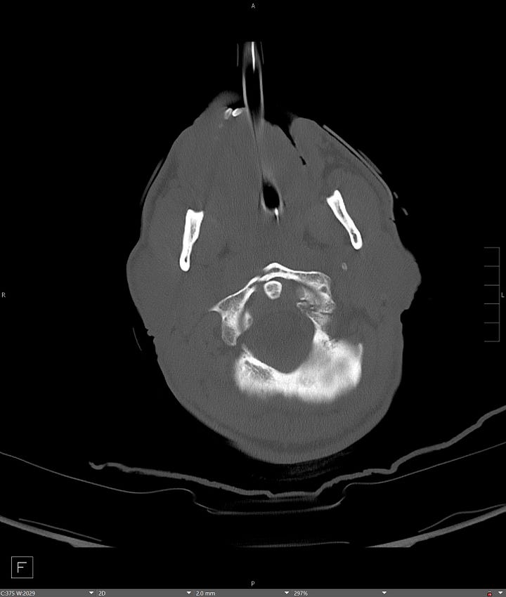 Occipital condyle fracture - by Alexander Baxter - RadNotes
