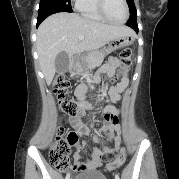Traumatic Pancreatic Injury - by Alexander Baxter
