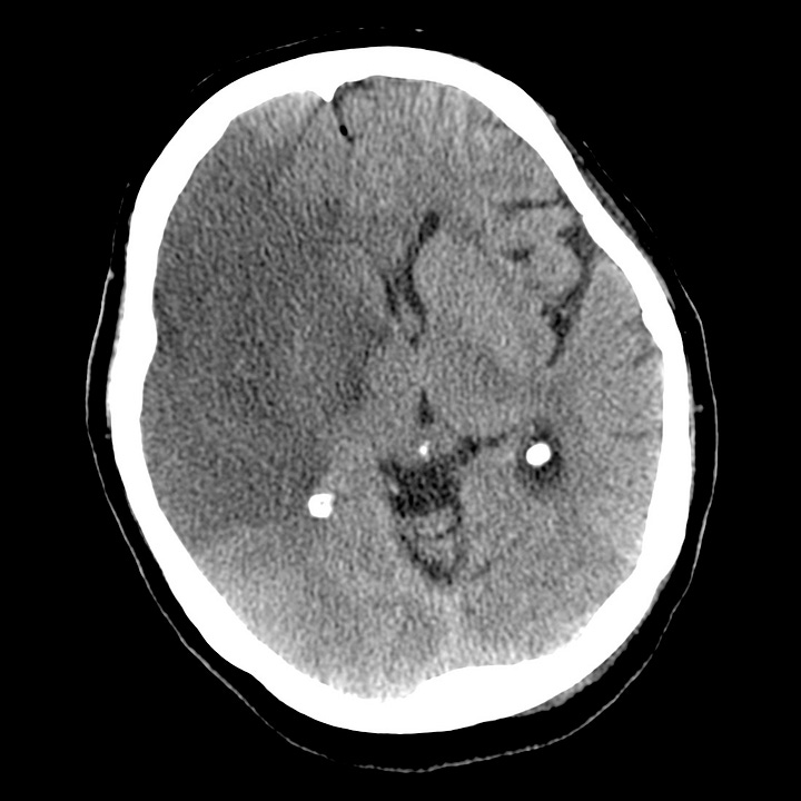 Cerebral edema patterns - RadNotes