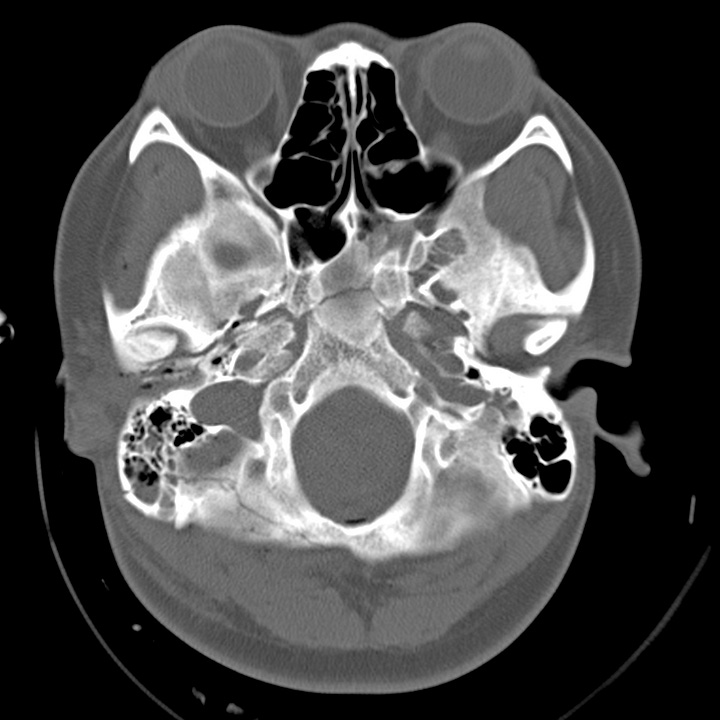 Skull fracture - by Alexander Baxter - RadNotes