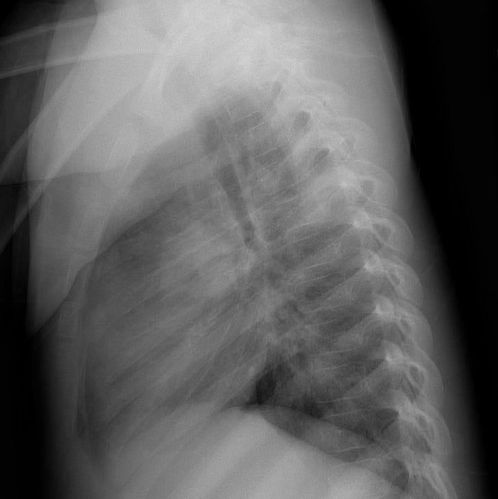 Bronchiolitis and acute pediatric pneumonia
