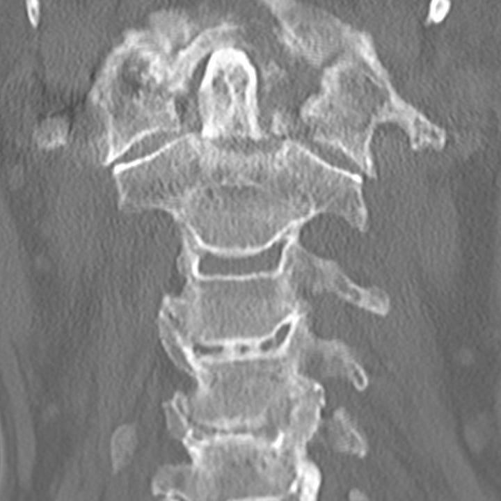 Odontoid (dens) fracture - by Alexander Baxter - RadNotes