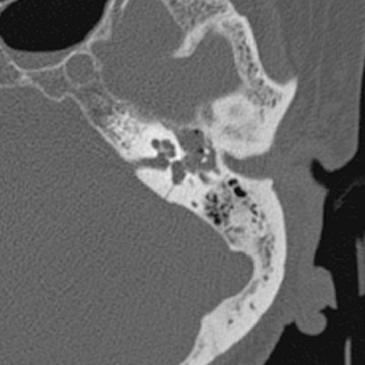 Temporal bone fracture - by Alexander Baxter - RadNotes