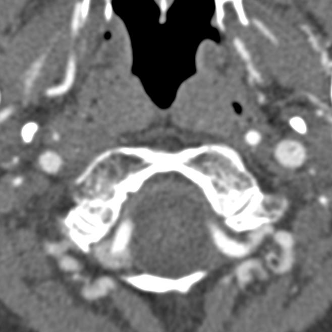 Cervical vascular injury - by Alexander Baxter - RadNotes