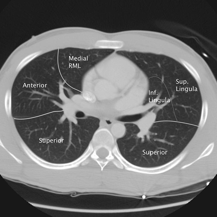 Chest anatomy - radiographs and CT - by Alexander Baxter