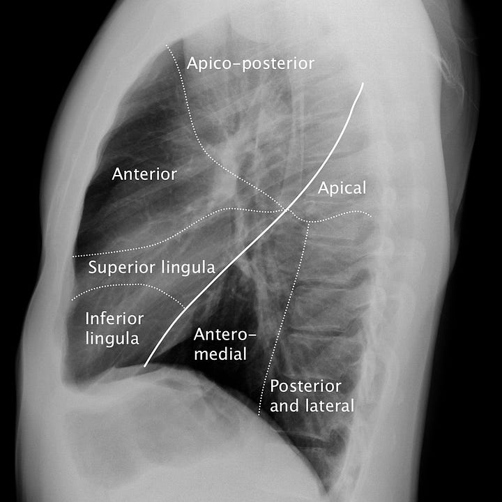 Chest anatomy - radiographs and CT - by Alexander Baxter