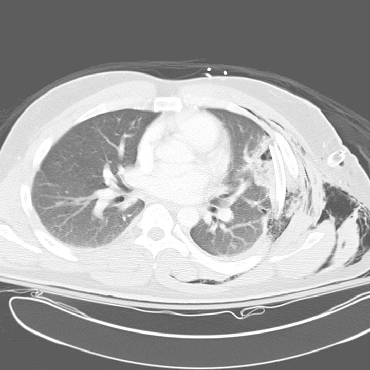 Chest wall injuries - by Alexander Baxter - RadNotes