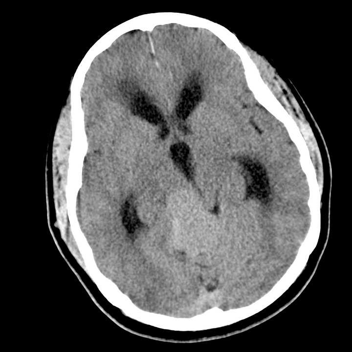 Cerebral edema patterns - RadNotes