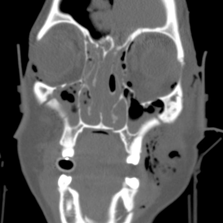 Le Fort Fractures - by Alexander Baxter - RadNotes