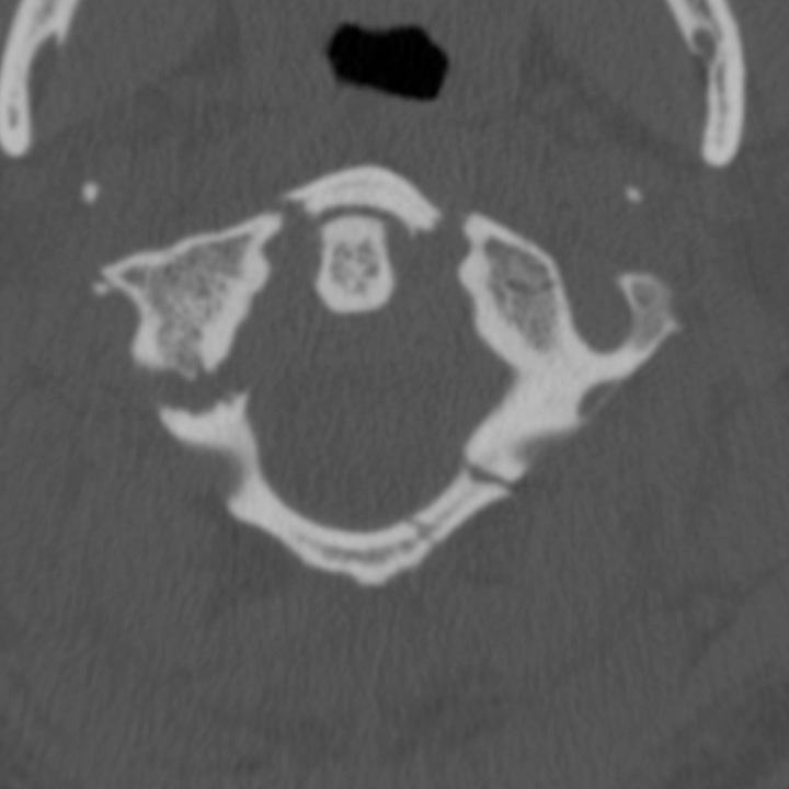 C1 "Jefferson" fracture - by Alexander Baxter - RadNotes