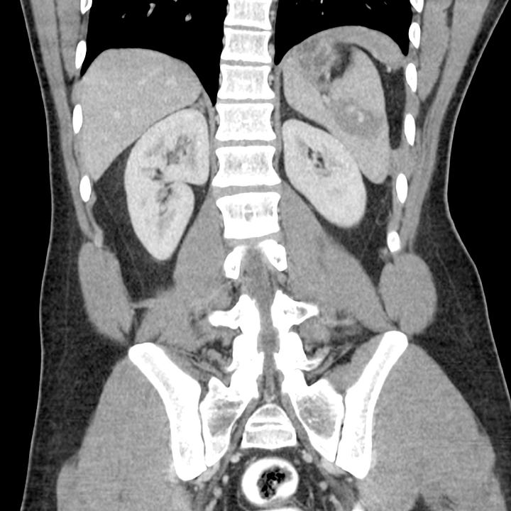 Splenic injury - by Alexander Baxter - RadNotes