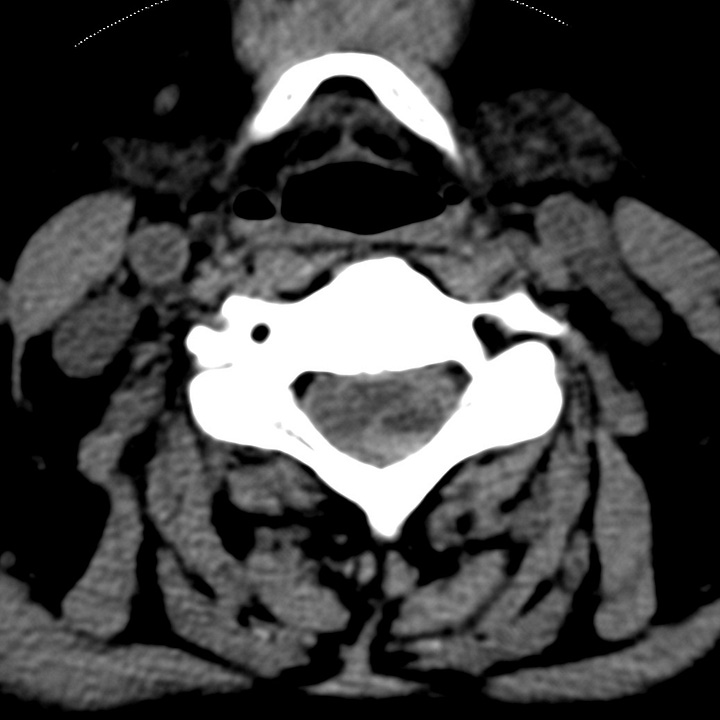Spinal epidural hematoma - by Alexander Baxter - RadNotes
