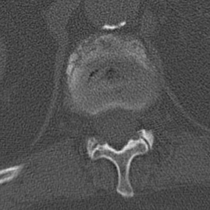 Vertebral compression fractures - by Alexander Baxter