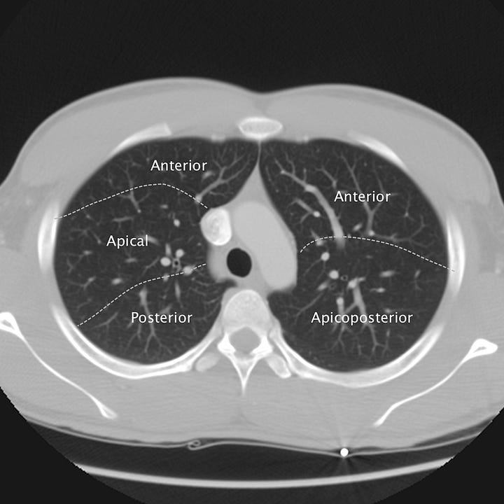 Chest anatomy - radiographs and CT - by Alexander Baxter