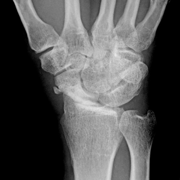 Scaphoid fracture and scapholunate dissocation
