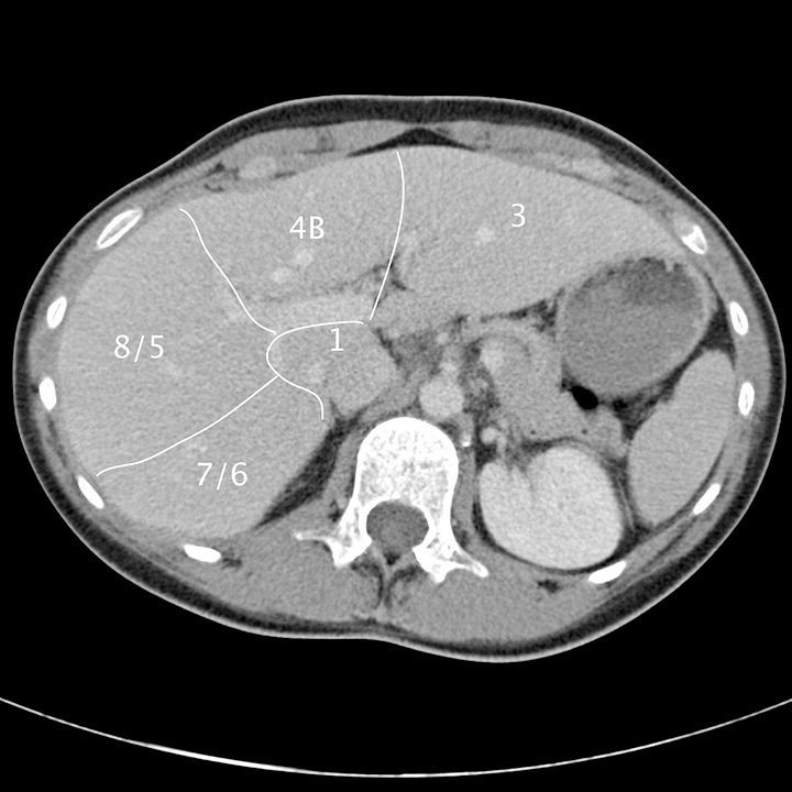 Hepatic segmental anatomy - by Alexander Baxter - RadNotes