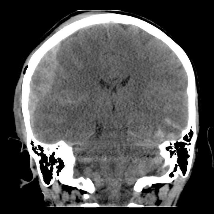 Epidural Hematoma - by Alexander Baxter - RadNotes
