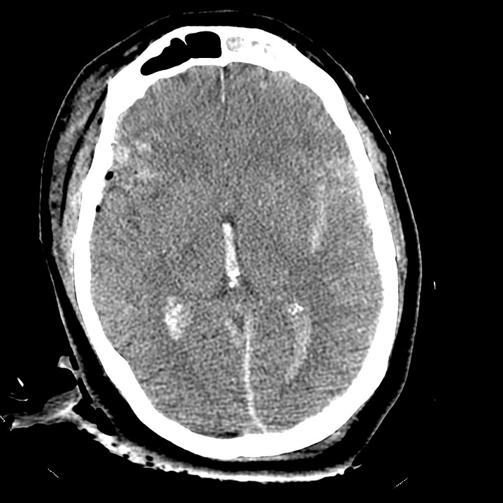 Traumatic subarachnoid hemorrhage - by Alexander Baxter