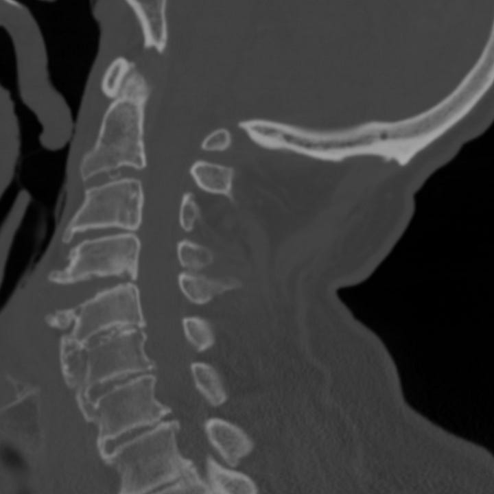 Cervical hyperextension injuries - by Alexander Baxter
