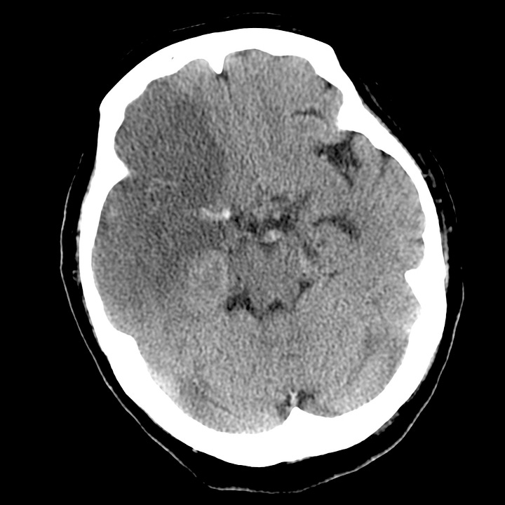 Cerebral edema patterns - by Alexander Baxter - RadNotes