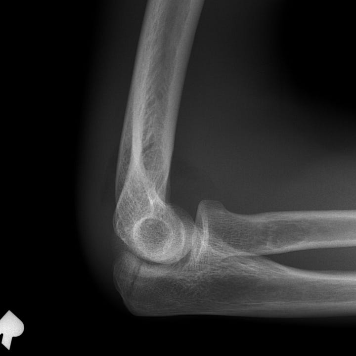 Olecranon fracture and triceps avulsion