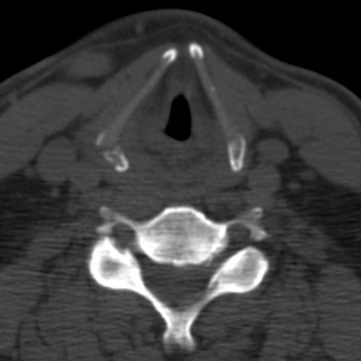 Laryngeal fracture - by Alexander Baxter - RadNotes