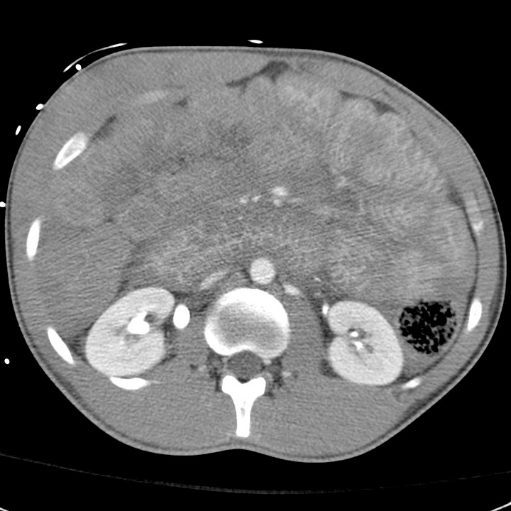 Small bowel injury - by Alexander Baxter - RadNotes