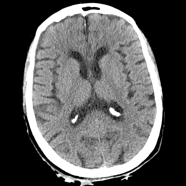 Subdural hygroma - by Alexander Baxter - RadNotes