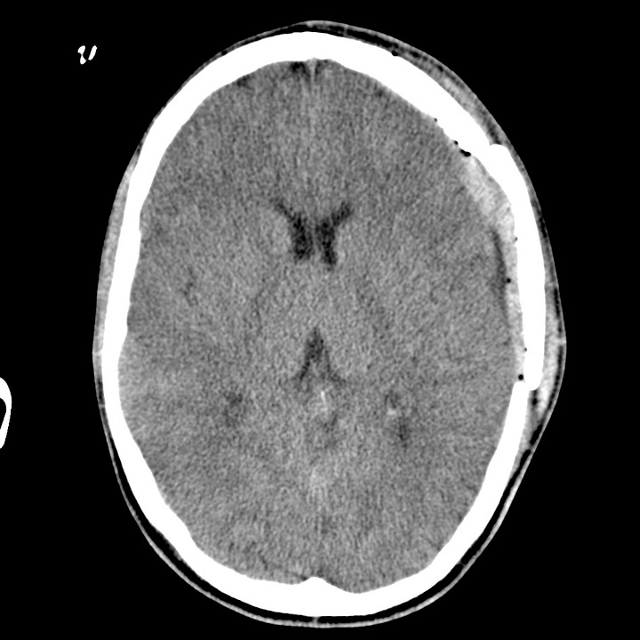 Skull fracture - by Alexander Baxter - RadNotes